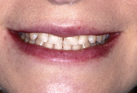 Cosmetic Dentisty: Before and After Photo Gallery